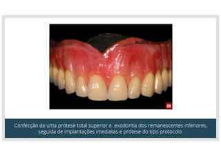 Prótese Total Fixa | PDF