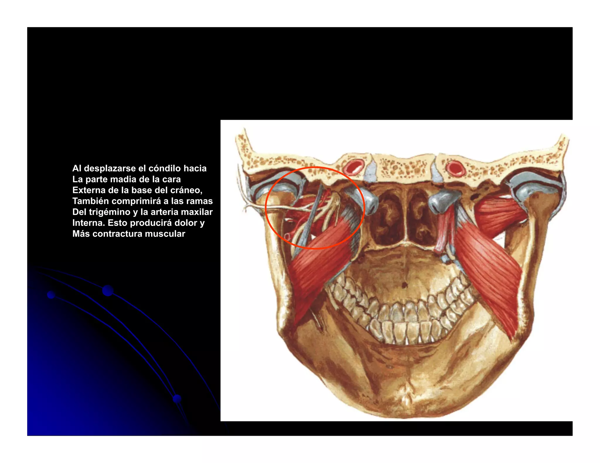 Protesis de condilo mandibular | PPT