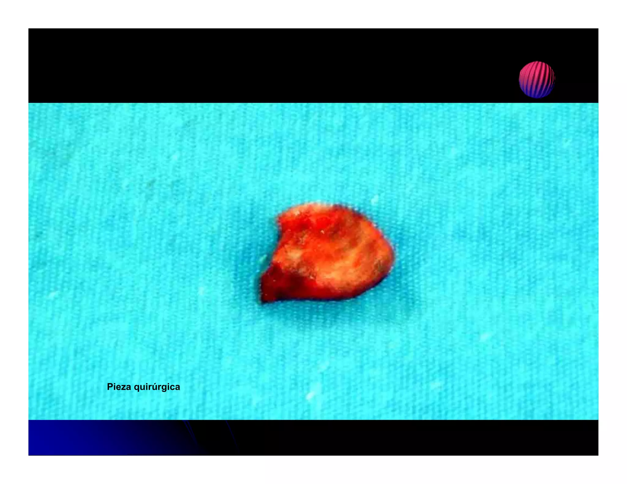 Protesis de condilo mandibular | PPT