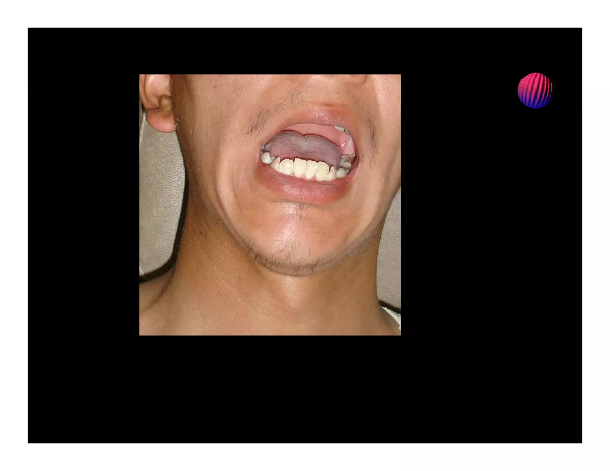 Protesis de condilo mandibular | PDF