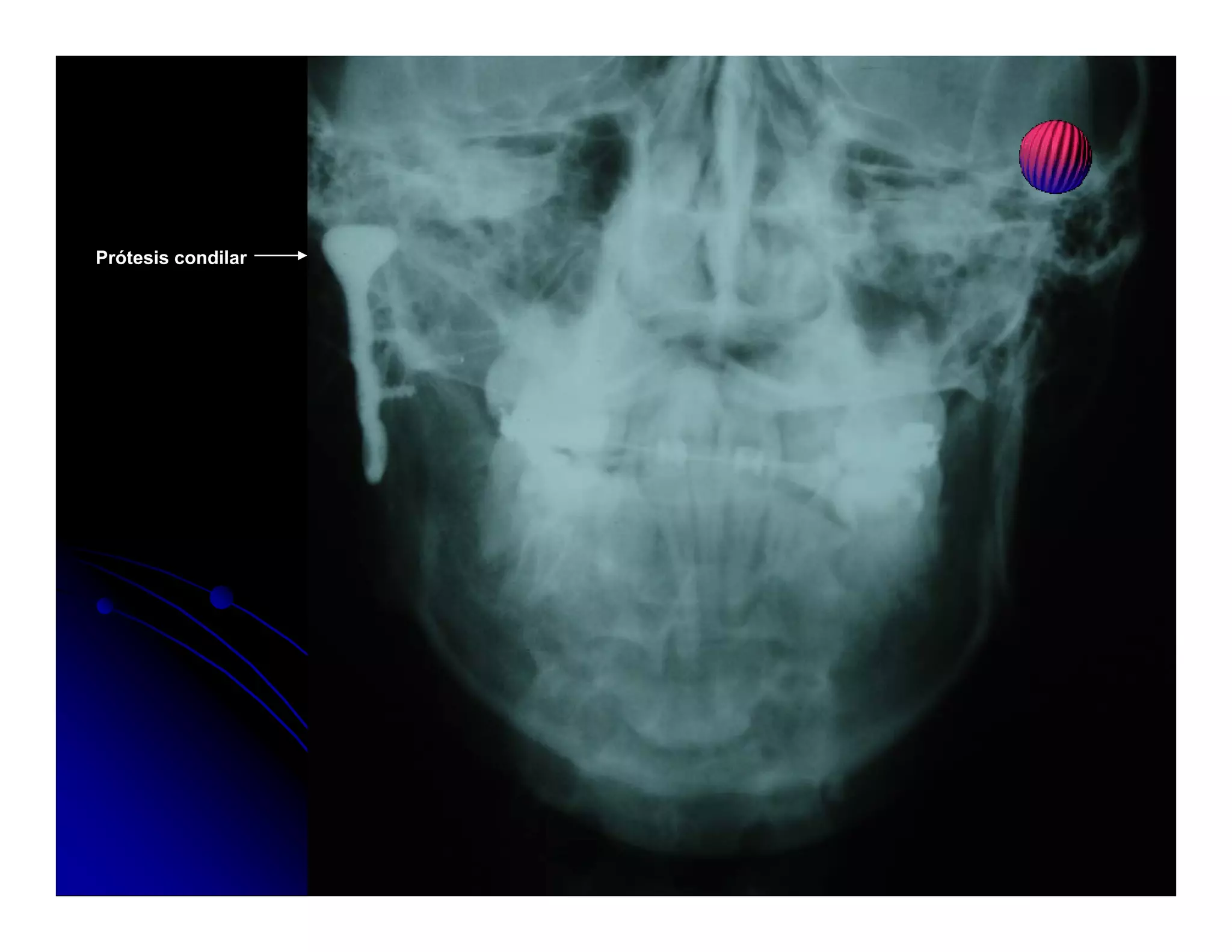 Protesis de condilo mandibular | PDF
