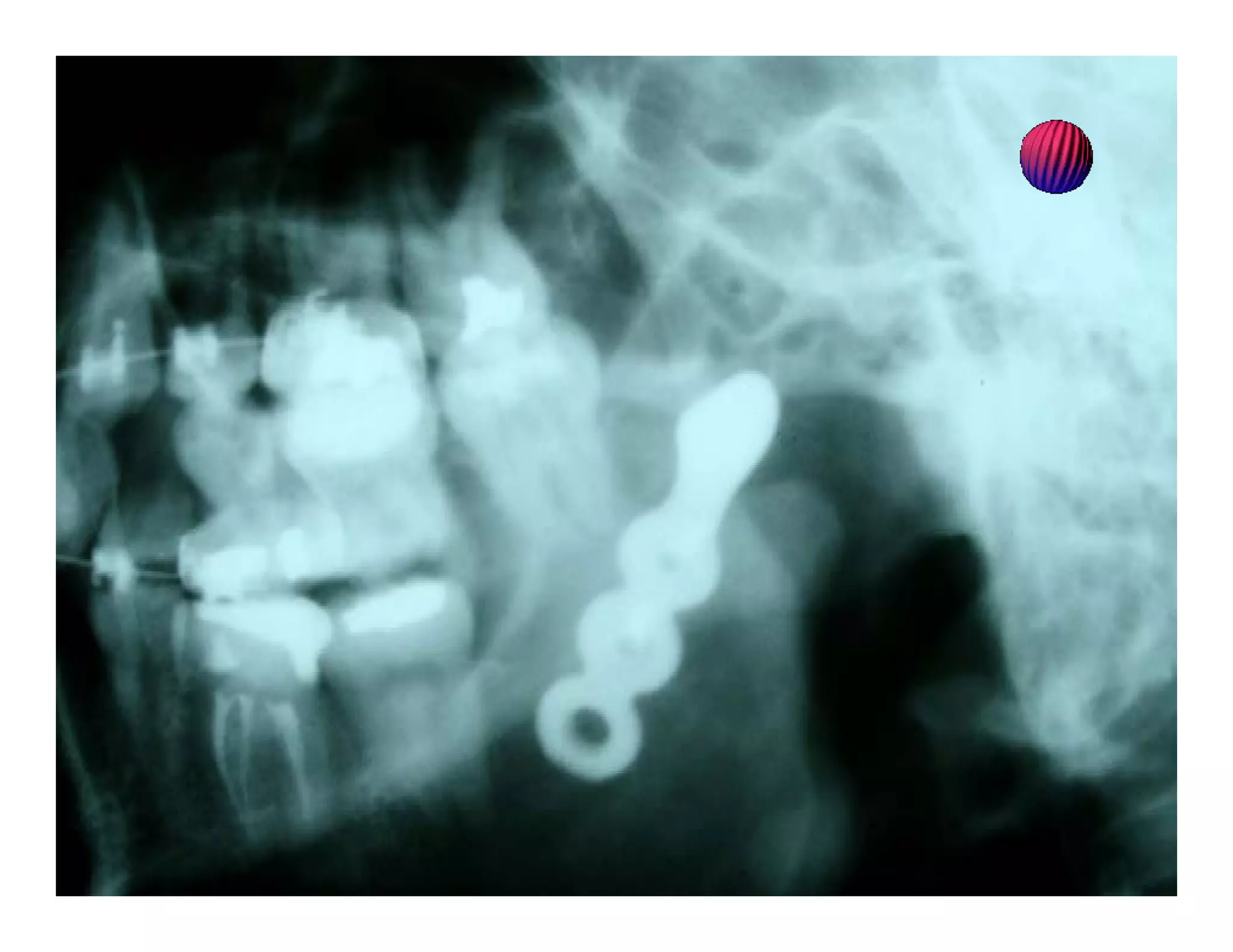 Protesis de condilo mandibular | PDF
