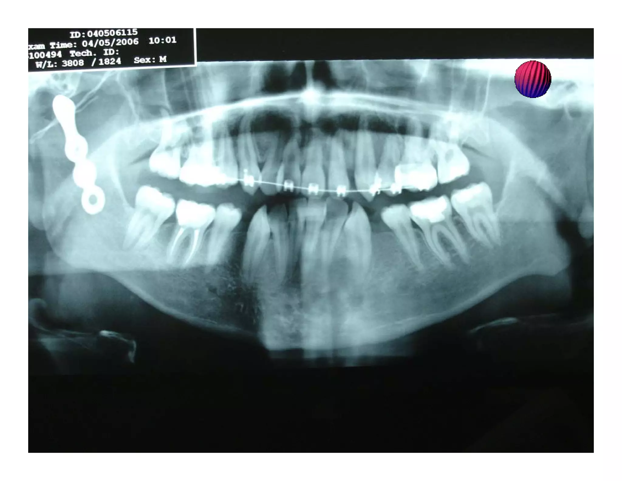 Protesis de condilo mandibular | PDF