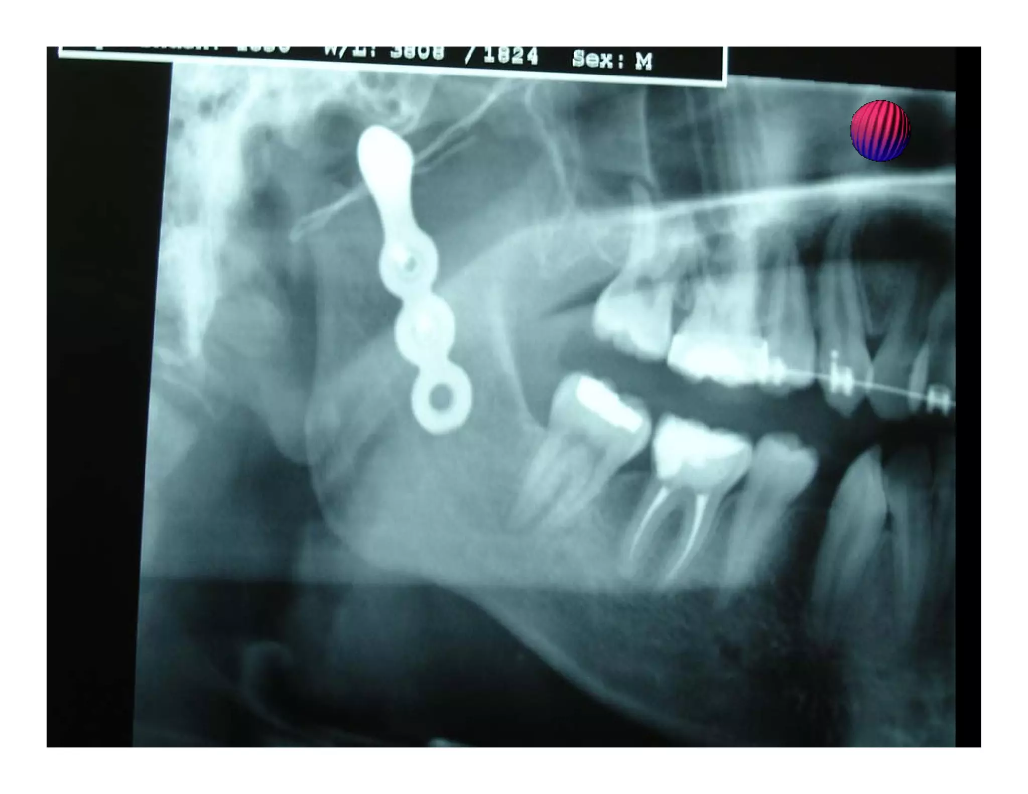 Protesis de condilo mandibular | PDF