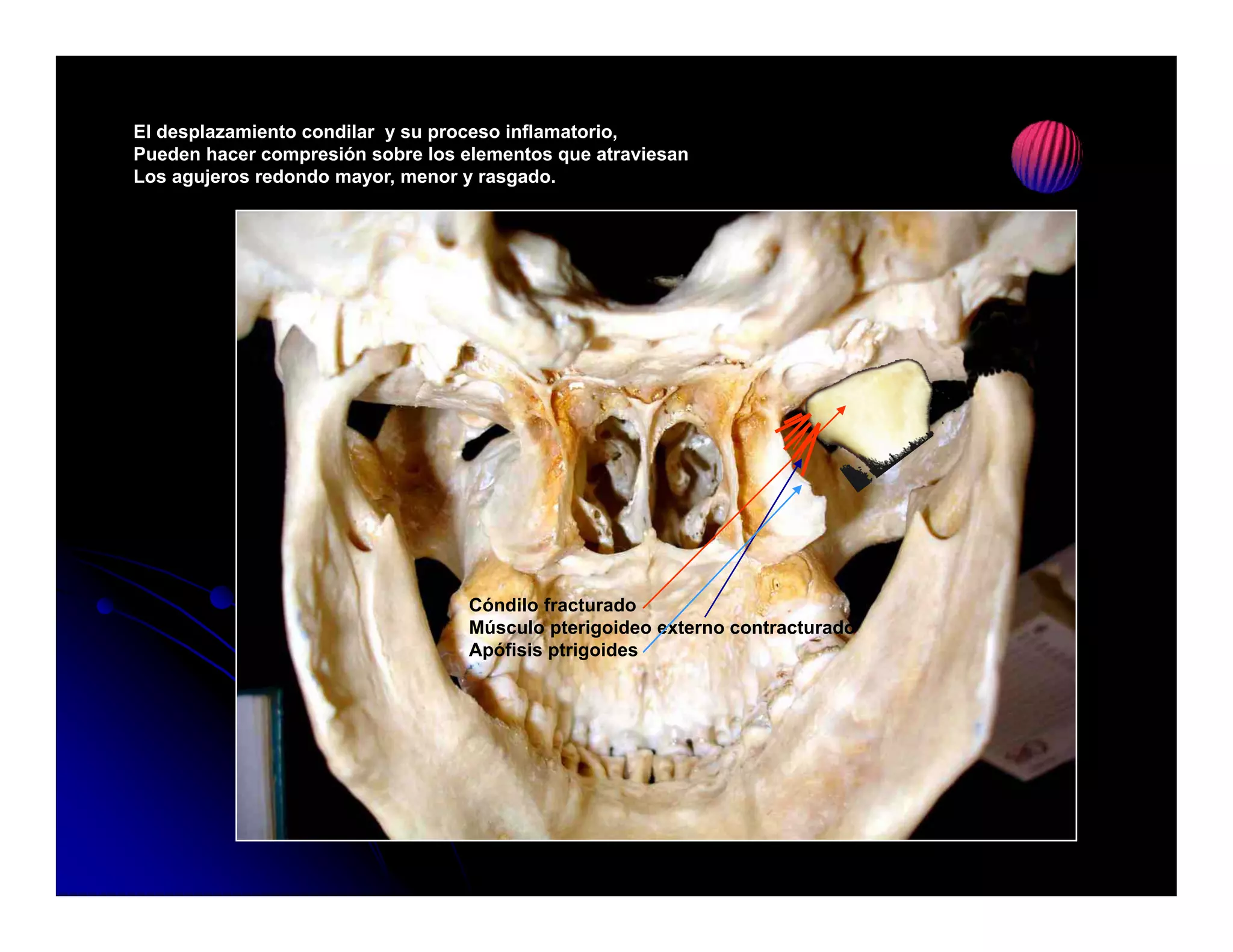 Protesis de condilo mandibular | PPT