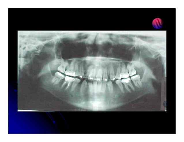 Protesis de condilo mandibular | PPT