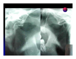 Protesis de condilo mandibular | PDF