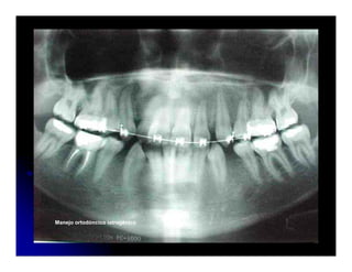 Protesis de condilo mandibular | PDF