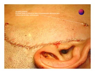 Protesis de condilo mandibular | PDF
