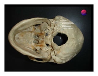 Protesis de condilo mandibular | PDF