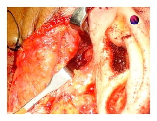 Protesis de condilo mandibular | PDF