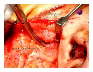Protesis de condilo mandibular | PDF