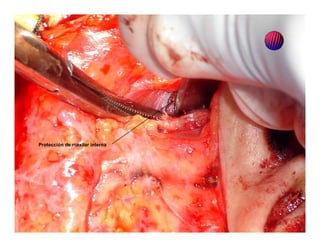 Protesis de condilo mandibular | PDF