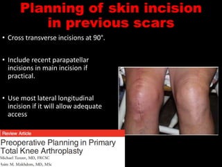 Protesis de rodilla | PPTX