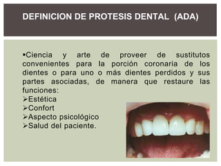 Protesis fija | PPTX
