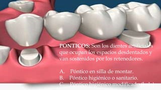 Protesis fija | PPTX
