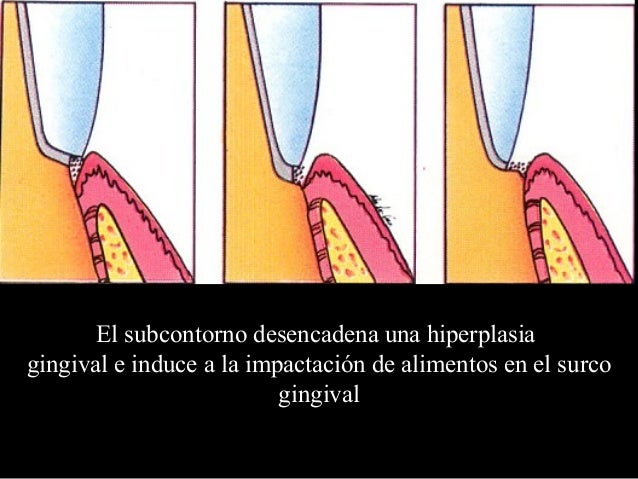 Protesis fija 1 ra y 2da semana