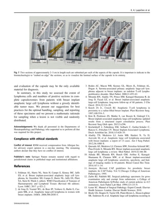 Protesis mamaria, linfoma anaplasico | PDF | Cancer | Diseases and ...