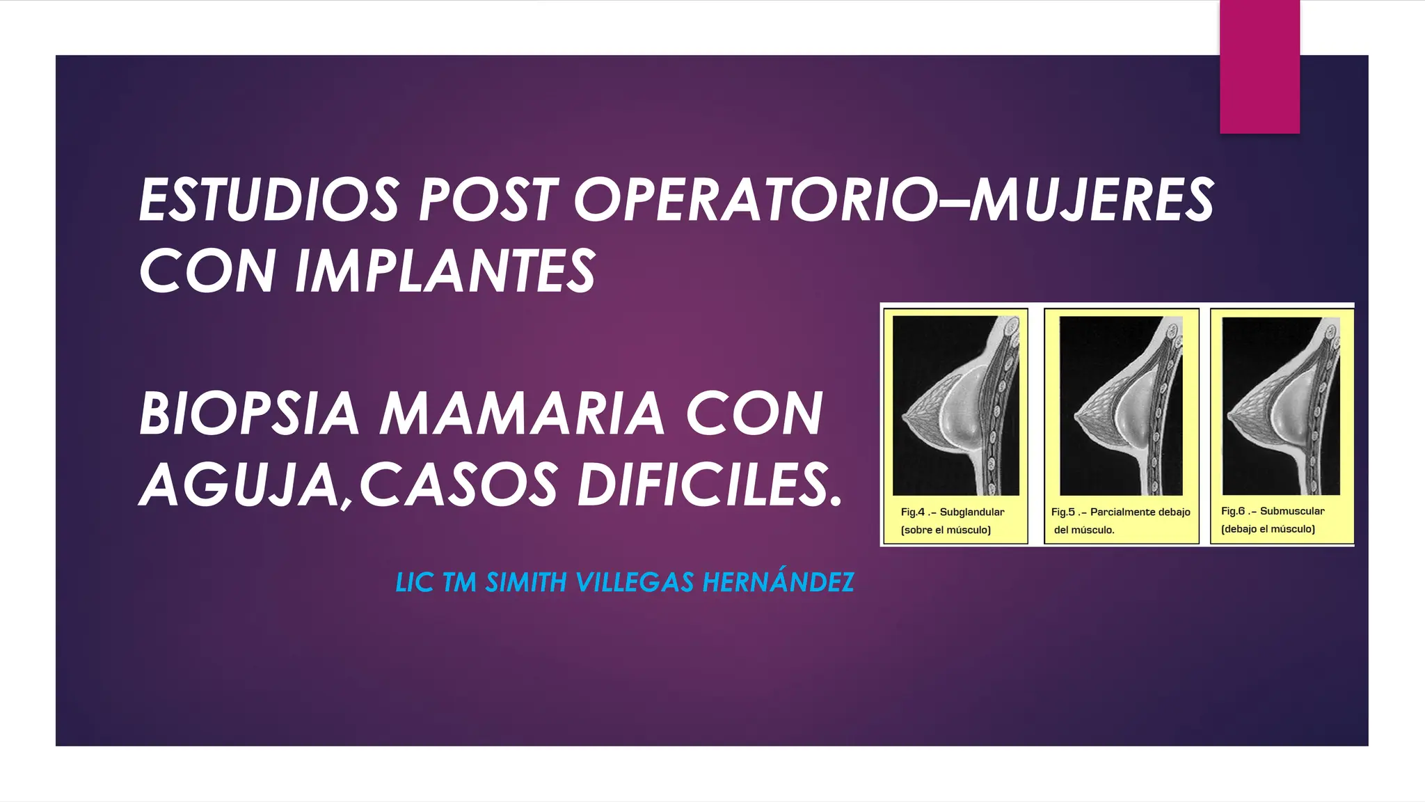 PROTESIS MAMA Y PROYECCIONES ESPECIALES | PPTX