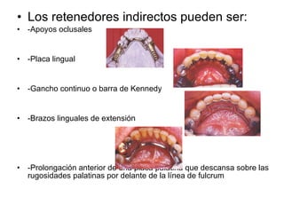 Protesis parcial removible | PPT