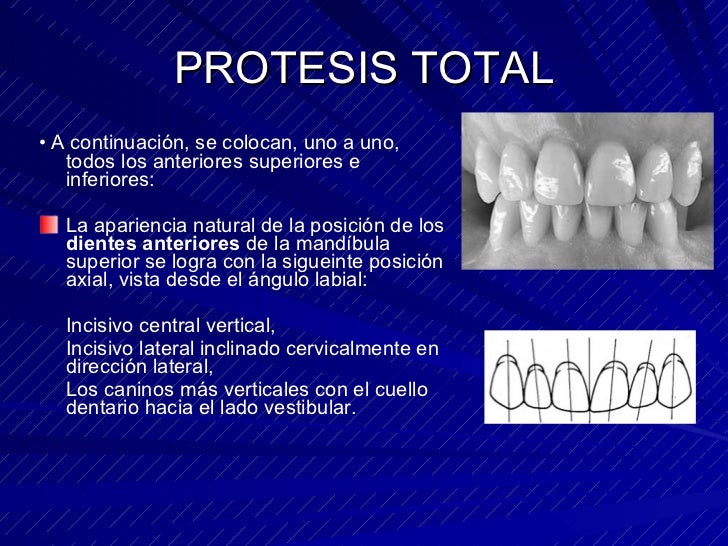 Protesis Total Final