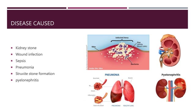 Proteus Mirabilis.pptx | Infectious Diseases | Diseases and Conditions