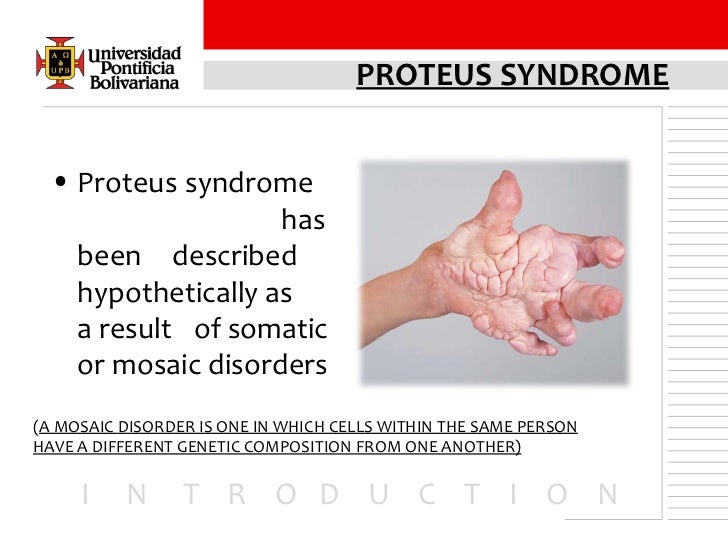 Proteus syndrome.