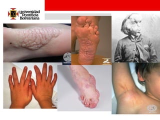 Proteus Syndrome Seminar | PPT