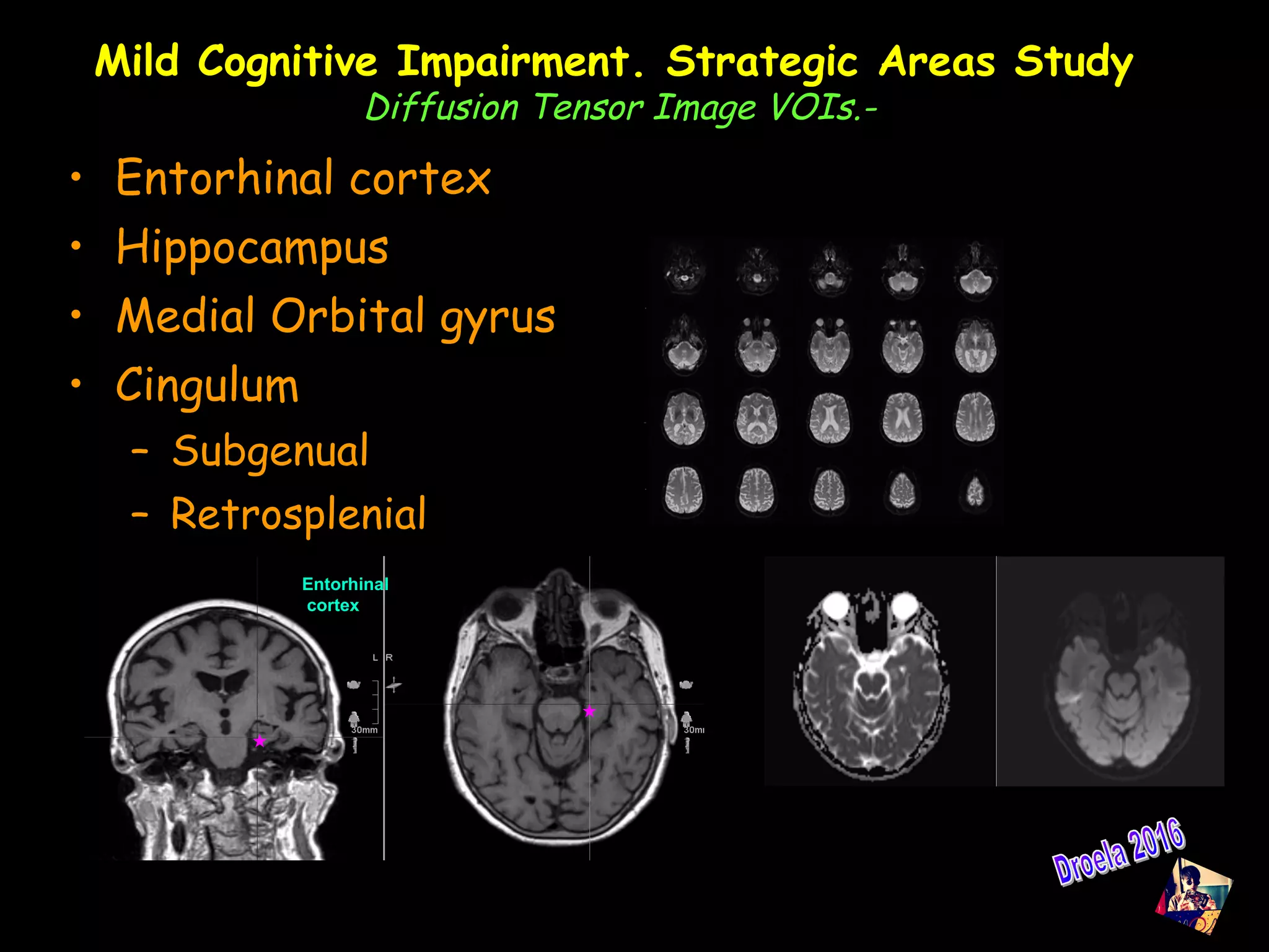 Mild cognitive Impairment & Dementia MRI Protocol | PPT