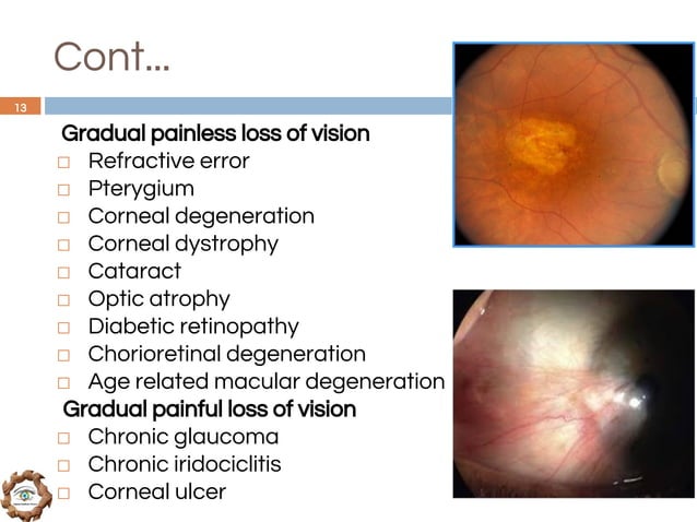 Protocol for differential diagnosis of common ocular diseases | PDF