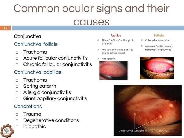 Protocol for differential diagnosis of common ocular diseases | PDF