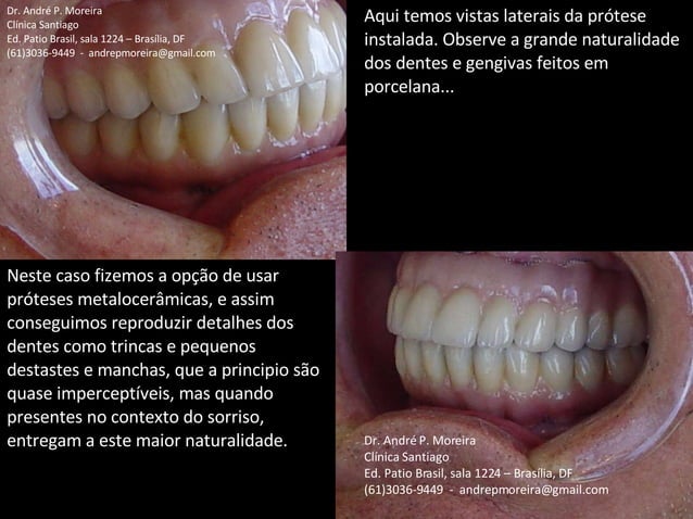 Protocolo De Branemark