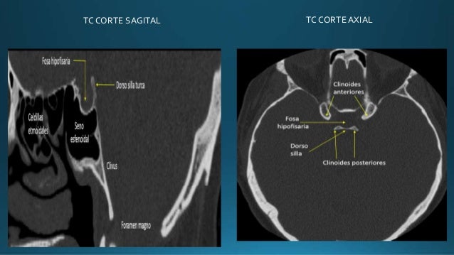 Protocolo de silla turca en tc