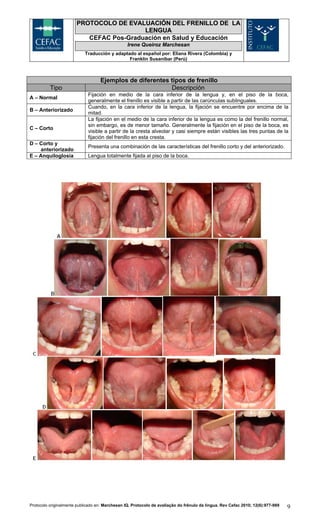 protocolo FRENILLO LINGUAL - MARCHESAN (1).pdf