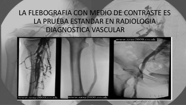 Protocolo para una flebografia