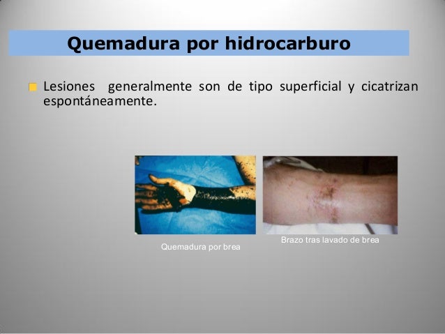 Protocolo quemaduras