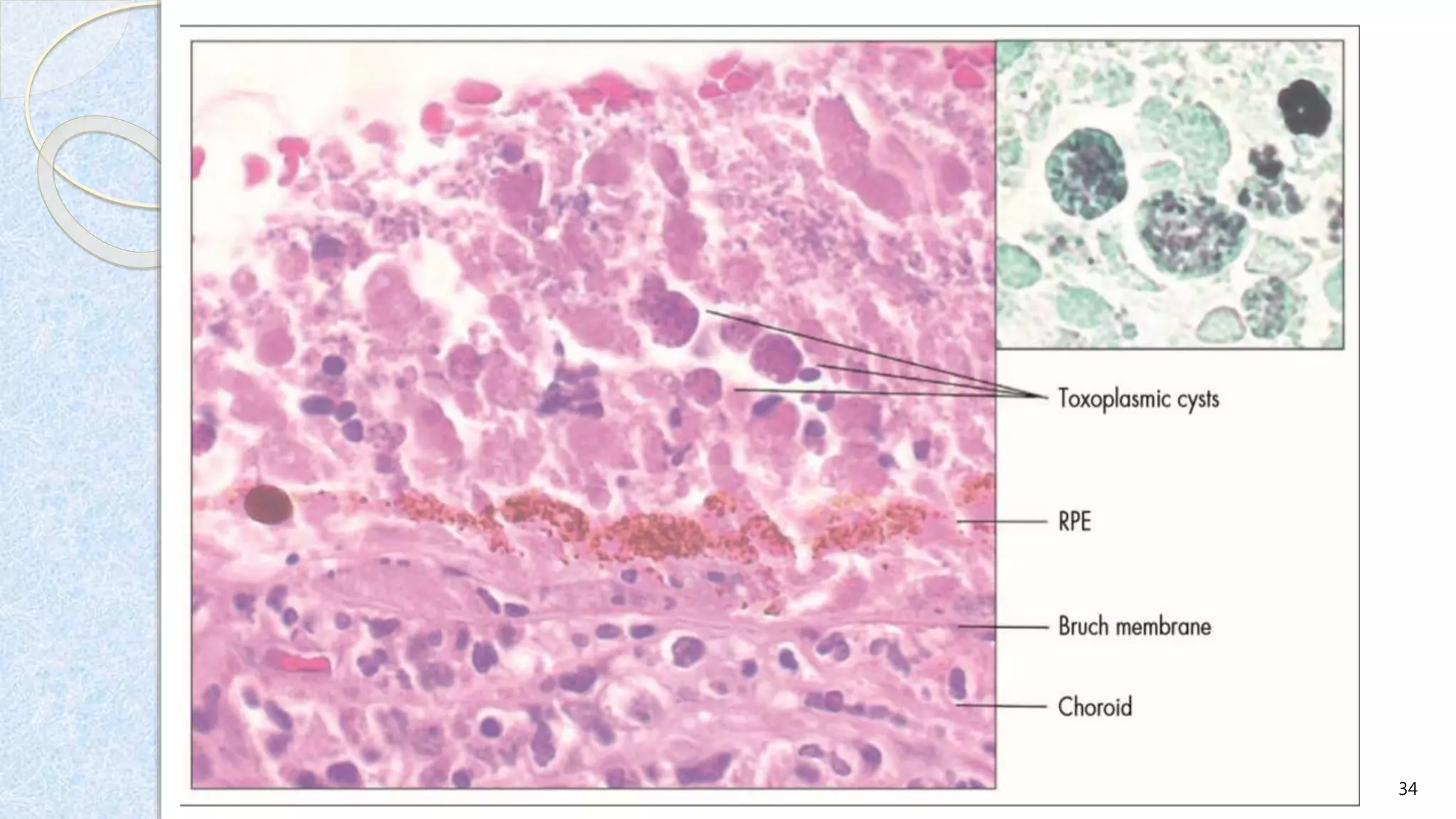 Protozoal uveitis- toxoplasmosis | PPTX | Eye and Vision Conditions ...
