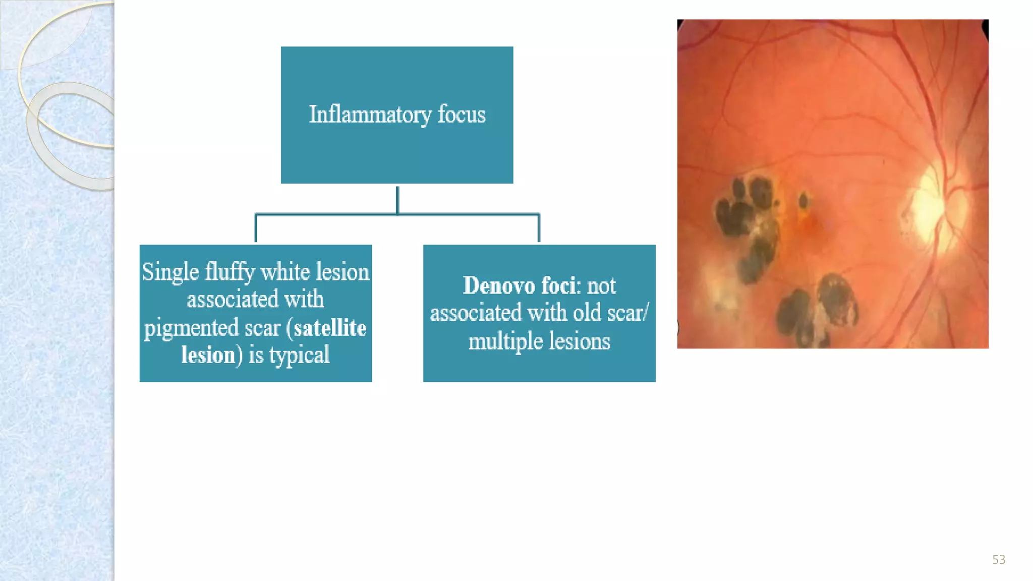 Protozoal uveitis- toxoplasmosis | PPTX | Eye and Vision Conditions ...