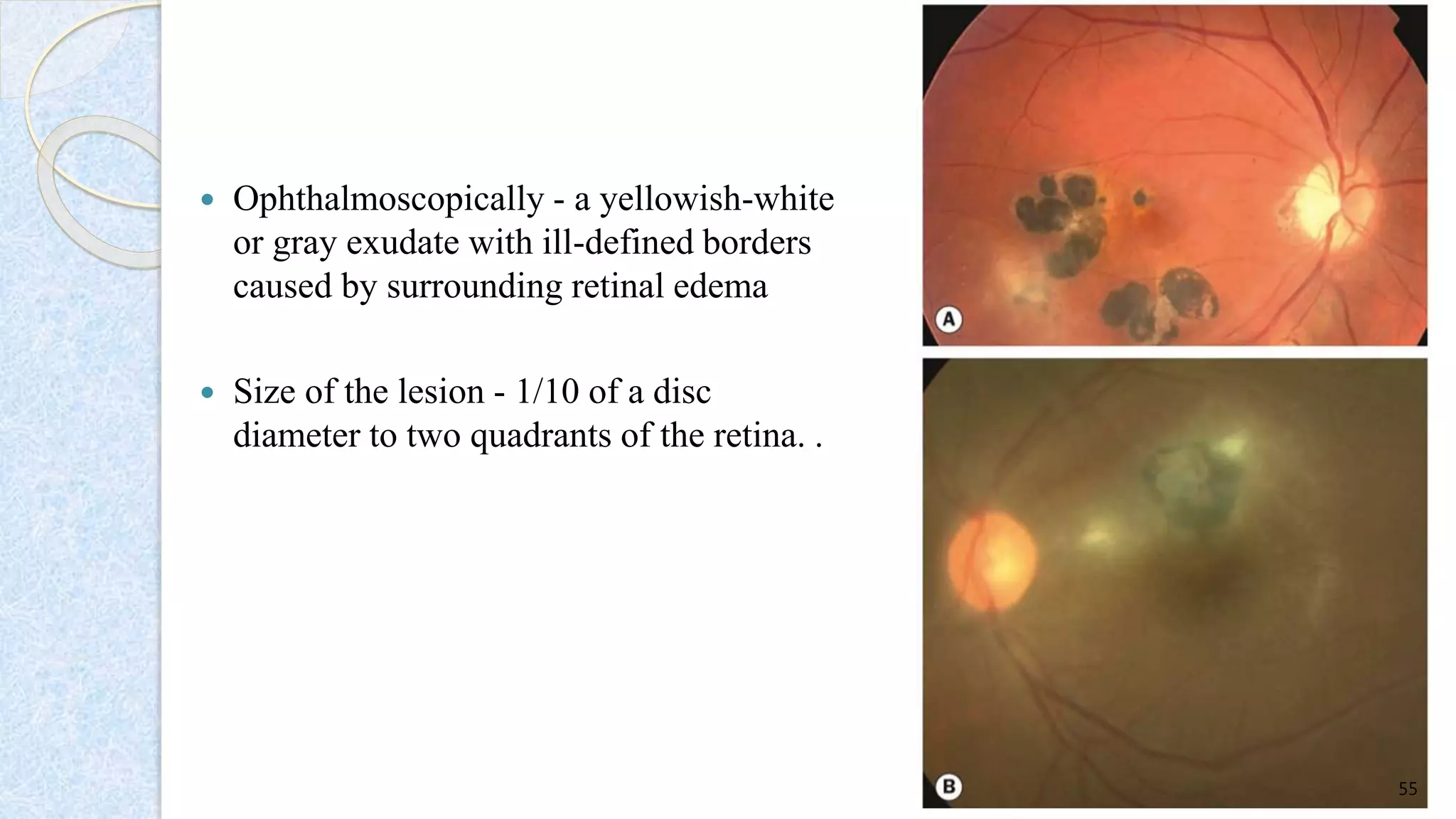 Protozoal uveitis- toxoplasmosis | PPTX | Eye and Vision Conditions ...