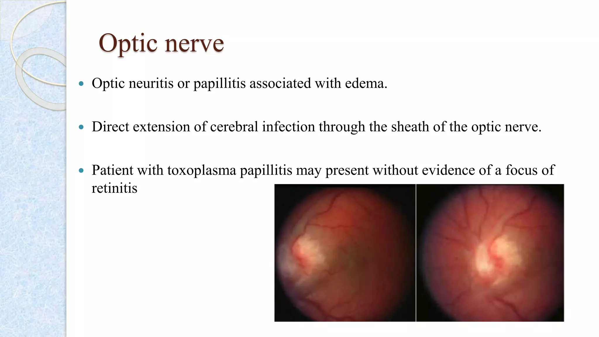 Protozoal uveitis- toxoplasmosis | PPTX | Eye and Vision Conditions ...