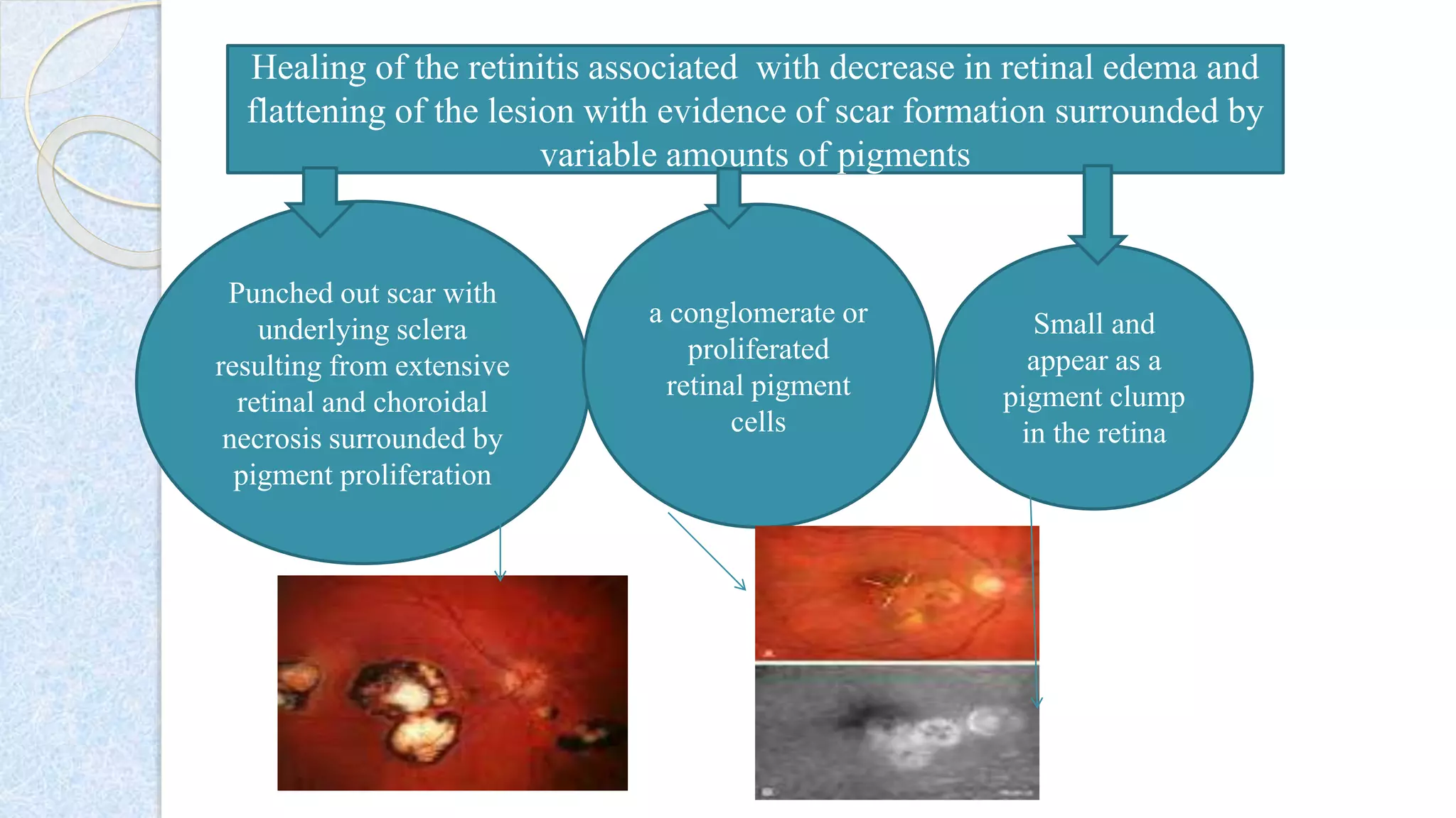 Protozoal uveitis- toxoplasmosis | PPTX | Eye and Vision Conditions ...