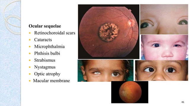 Protozoal uveitis- toxoplasmosis | PPTX | Eye and Vision Conditions ...