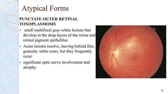 Protozoal uveitis- toxoplasmosis | PPTX | Eye and Vision Conditions ...