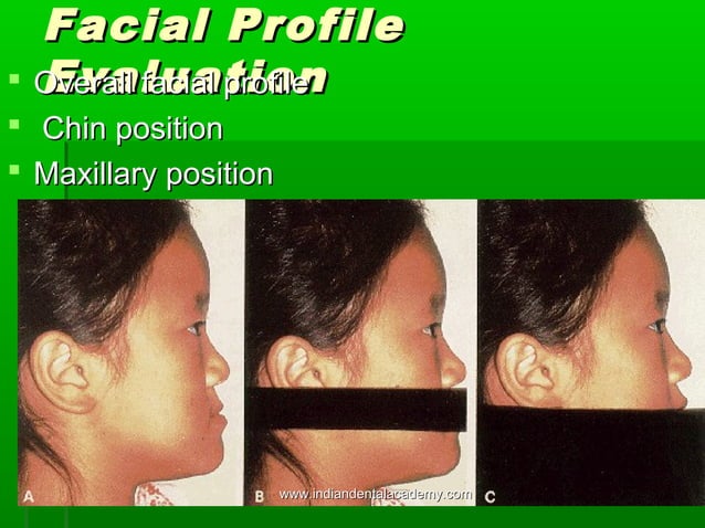 Protraction face mask /certified fixed orthodontic courses by Indian ...