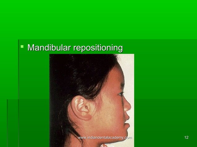 Protraction face mask /certified fixed orthodontic courses by Indian ...