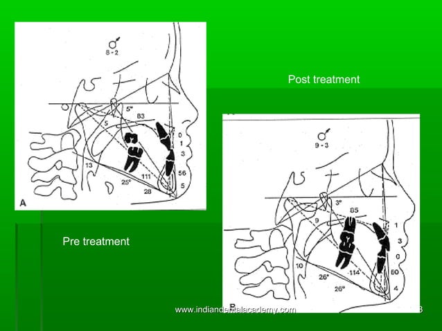 Protraction face mask /certified fixed orthodontic courses by Indian ...
