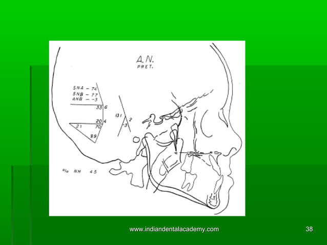 Protraction face mask /certified fixed orthodontic courses by Indian ...