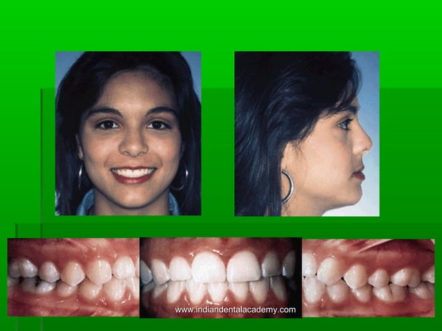 Protraction face mask /certified fixed orthodontic courses by Indian ...