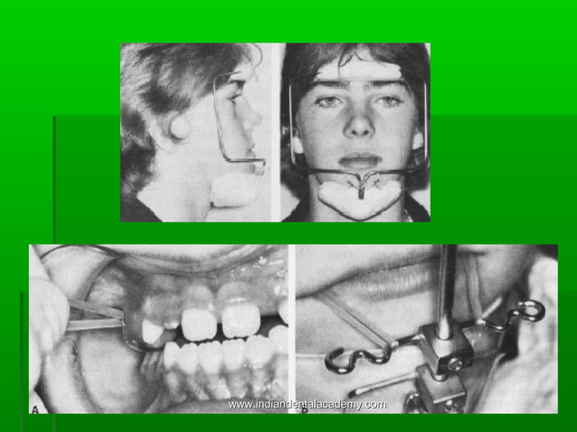 Protraction face mask /certified fixed orthodontic courses by Indian ...