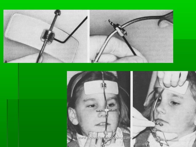 Protraction face mask /certified fixed orthodontic courses by Indian ...